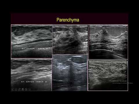 The implication of understanding Sonographic anatomy in interpreting Breast ultrasound(2)