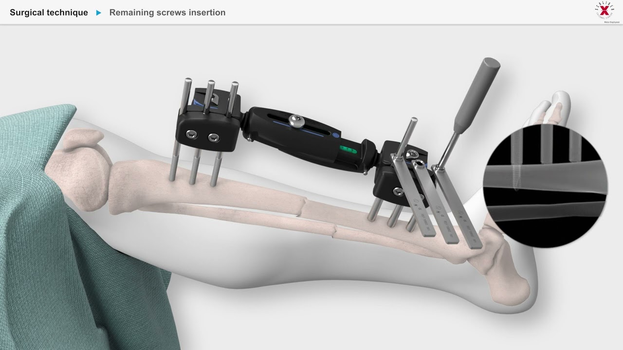 ORTHOFIX Surgical Devices