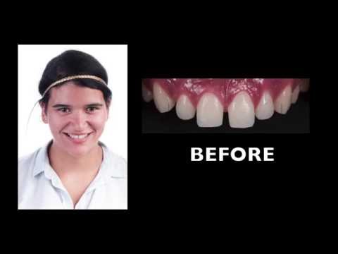 Tijuana Patient Review /Advanced Smiles Dentistry