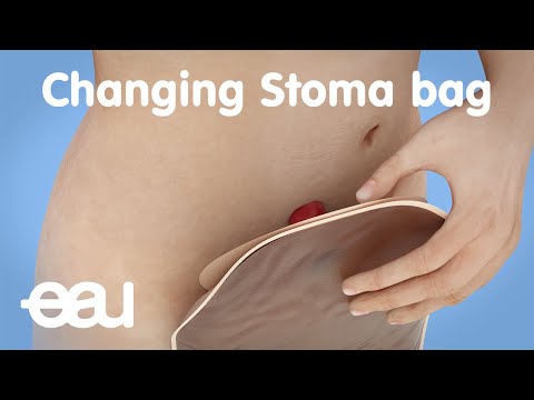 Changing stoma bag (after bladder cancer treatment)