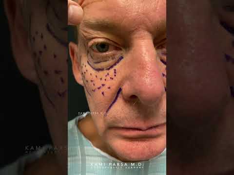 Lower Eye Bag Surgery and Hooded Eyelid Surgery for Men | Quadfecta Lift with Dr. Kami Parsa