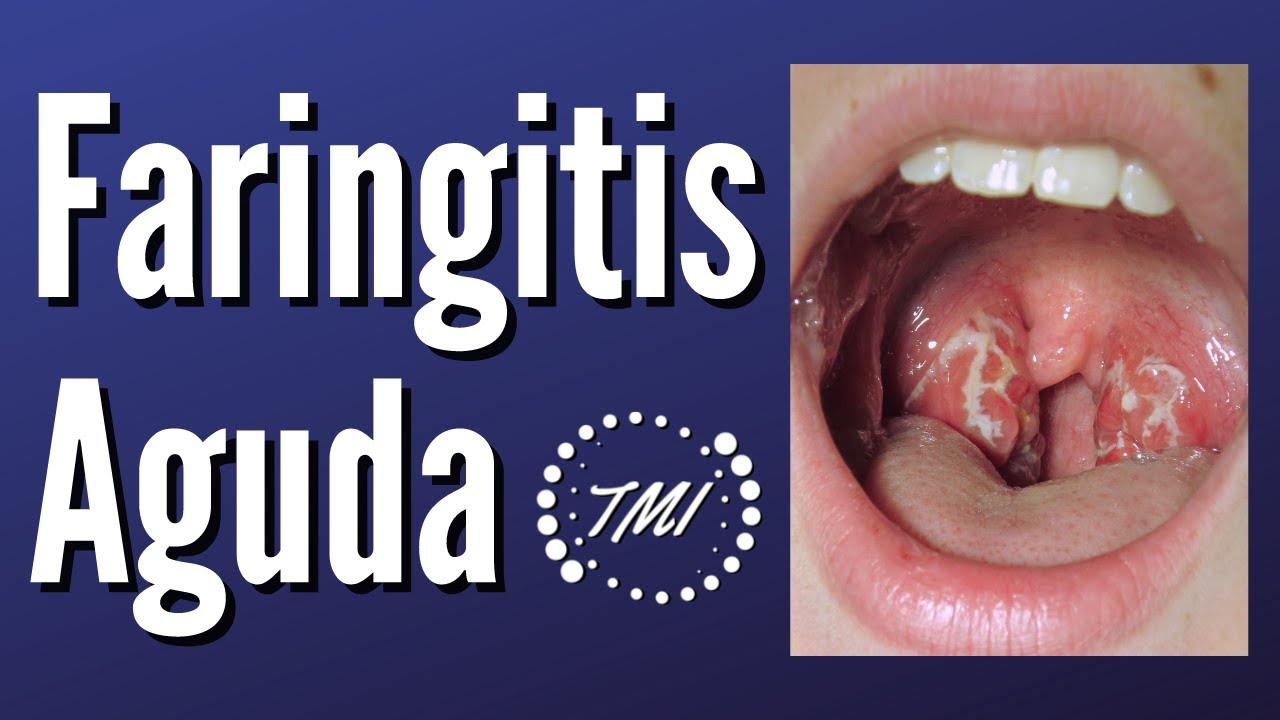 Faringoamigdalitis Aguda | Diagnóstico y Tratamiento