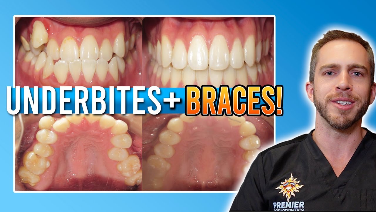 Underbite Braces Treatment W/ Rubber Bands! [BEFORE & AFTER]