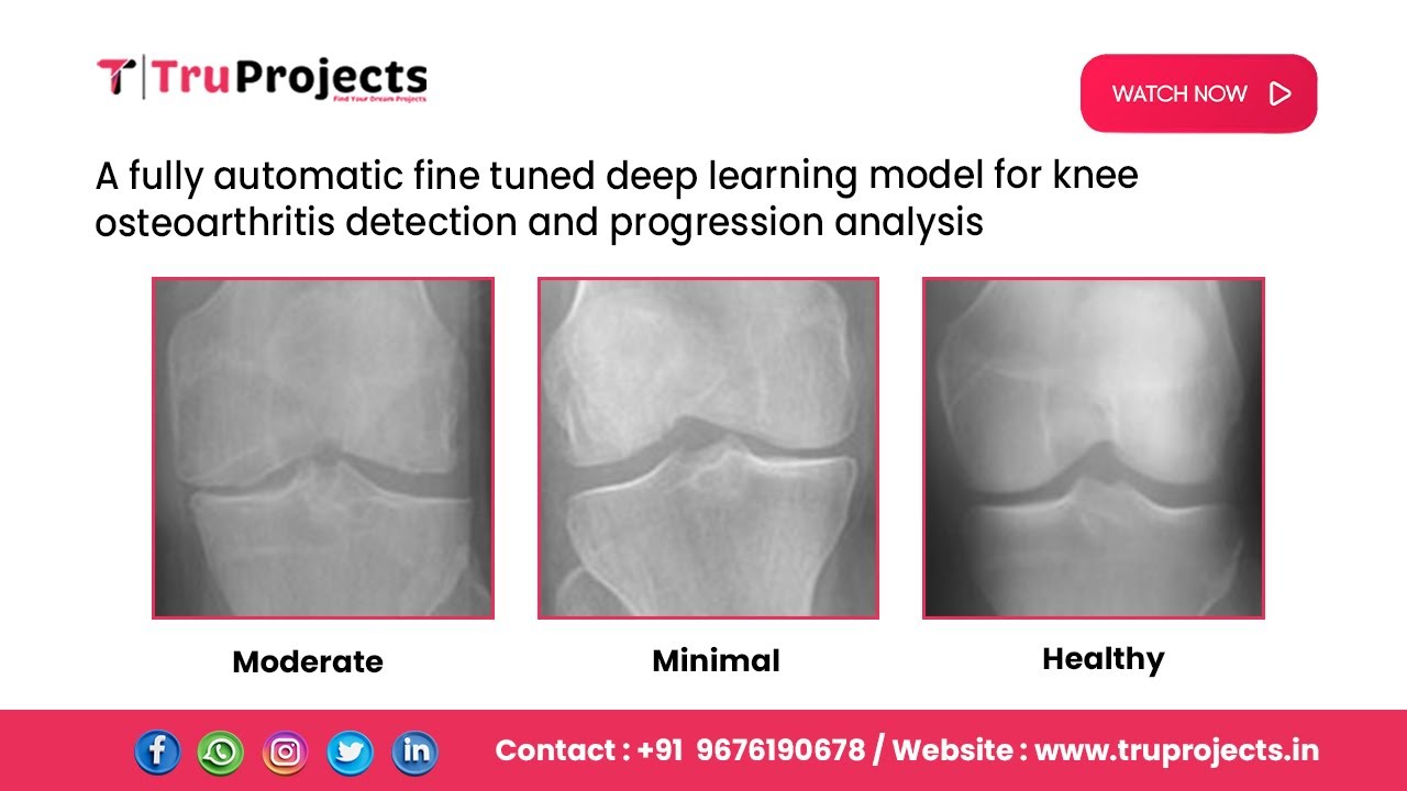 A fully automatic fine tuned deep learning model for knee osteoarthritis detection and progression a