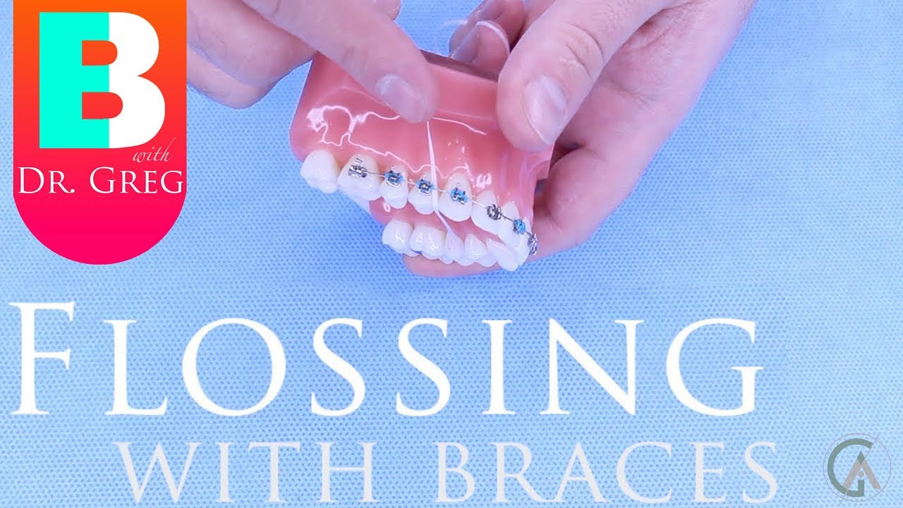 How to Floss with Braces (SuperFloss, Platypus, SoftPicks, etc)