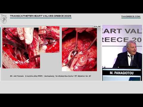 M. Panagiotou | Surgical therapies for MV/AV PVLs