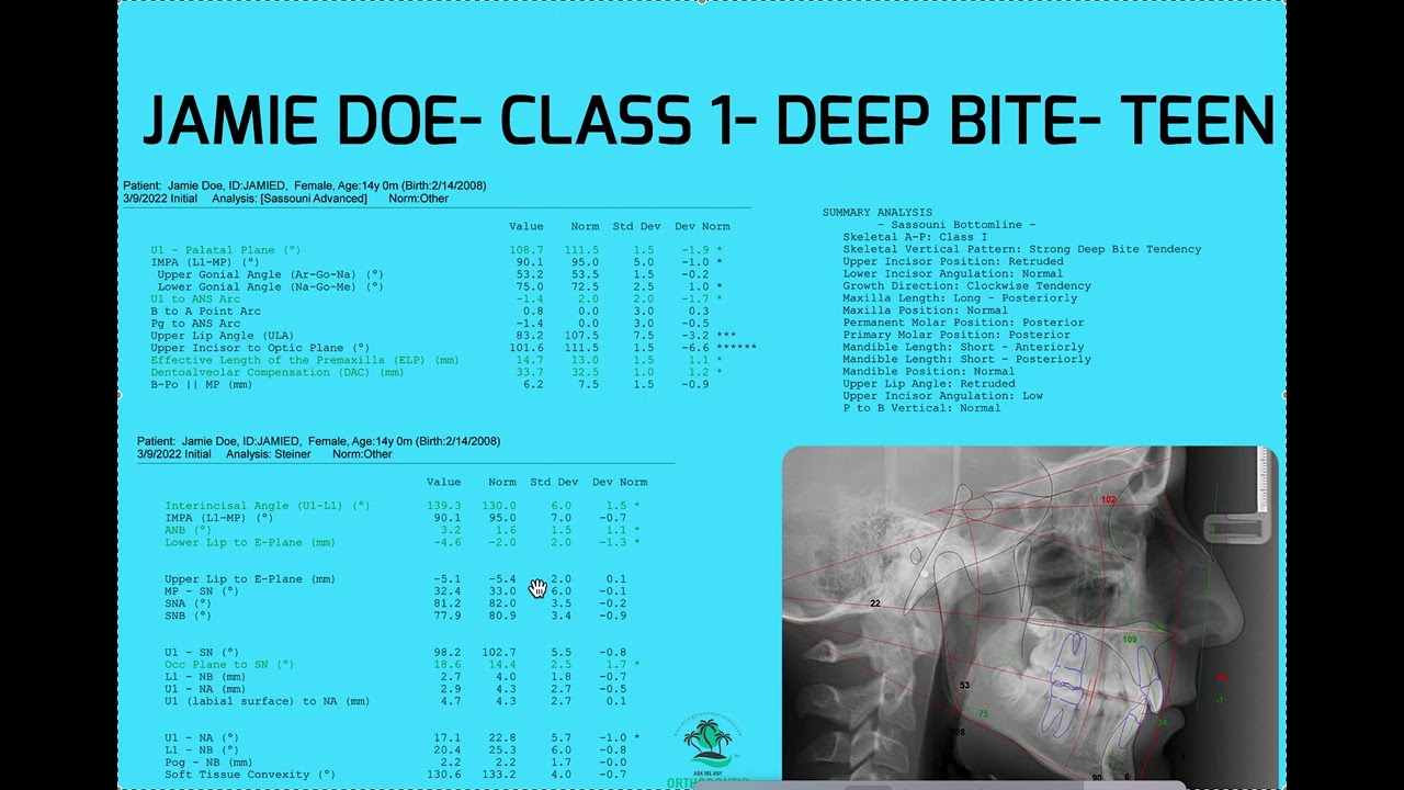 Class 1 Deepbite Ceph Case Teen