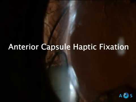Managing a Dislocated Intraocular Lens by Anterior Capsule Haptic Fixation: a new original technique