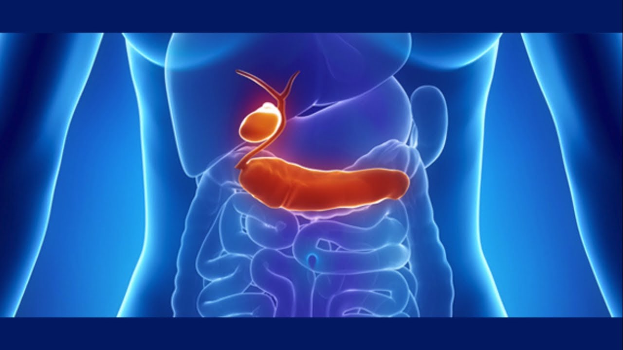 Cancer Ampular: síntomas, tratamiento. #ampuloma, #cancerdeduodeno, #cancerdepapiladeVater