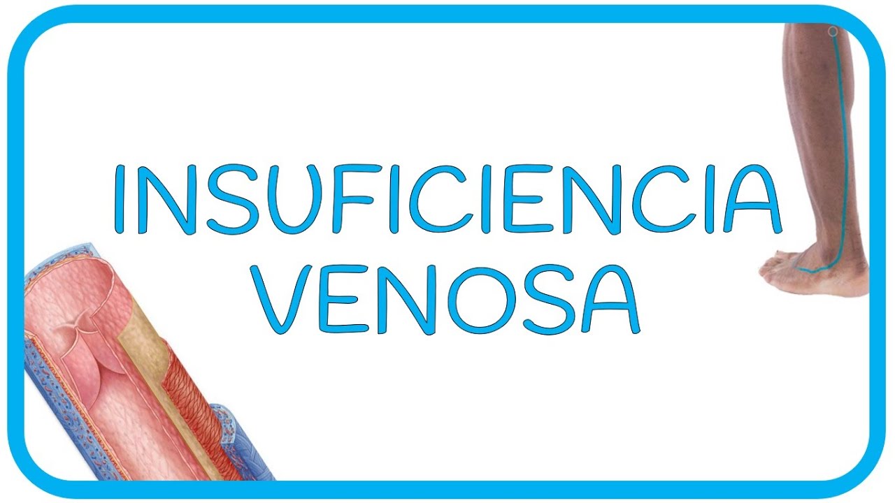 INSUFICIENCIA VENOSA - Causas, fisiopatología, síntomas, diagnóstico y tratamiento  |  CIRUGÍA
