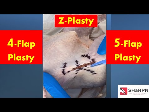 Mastering Plastic Surgery Techniques: Z-plasty, 4-Flap & 5-Flap plasty explained with chickens!