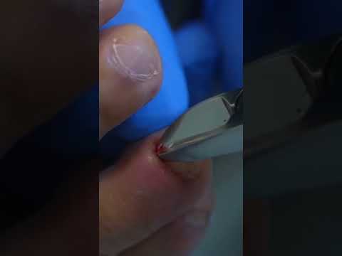 Cutting and fixing an ingrown toenail. #ingrown_toenail #ingrown_toenail_surgery