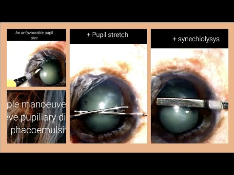 Simple manoeuvres to dilate the pupil during Phaco - without resorting to pupil dilating devices