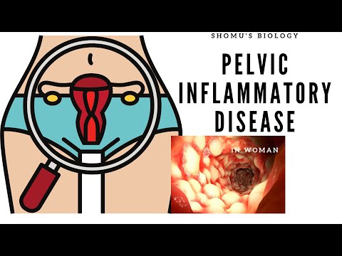 Pelvic inflammatory disease in Hindi | Symptoms, treatment in females