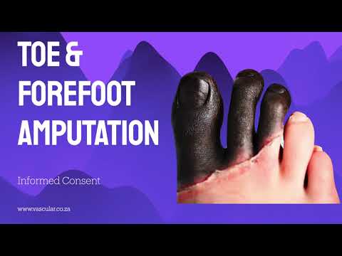 Toe and Forefoot Amputation - Informed Consent
