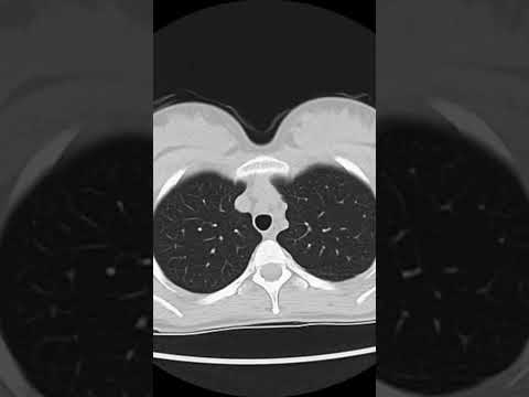 Normal Chest CT of Lungs