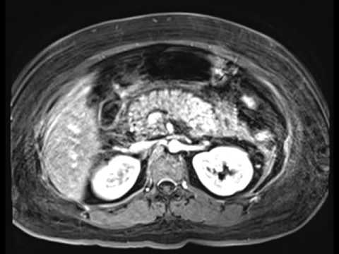 Acute Pancreatitis