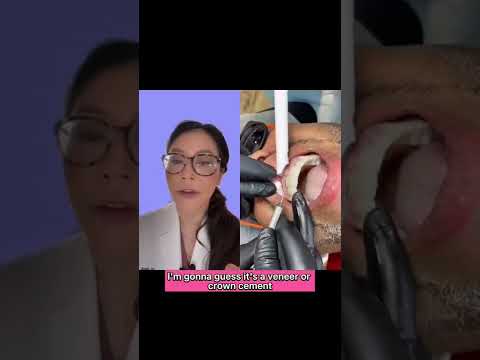 Removing cement from the margins of a crown #crown