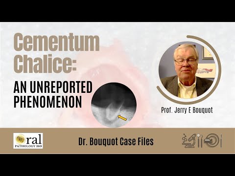 The Cementum Chalice: A Hidden Finding in Tooth Extractions #oralpathology360 #DrBouquot