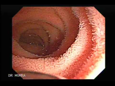 Endoscopy of the Terminal Ileum