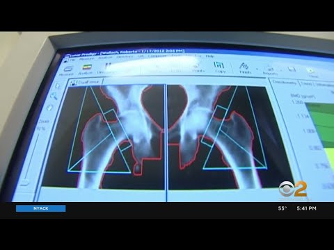 Bone Health A Growing Concern For Millions Of Older Women