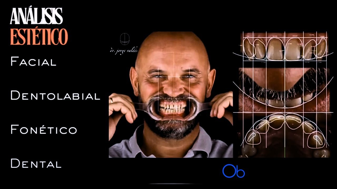 Aesthetic analysis: facial, dentolabial, phonetic and dental