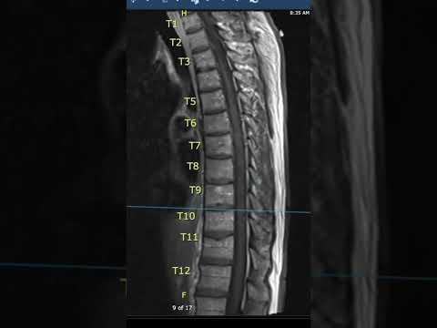 Thoracic Spine MRI