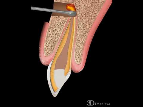 Apicoectomy