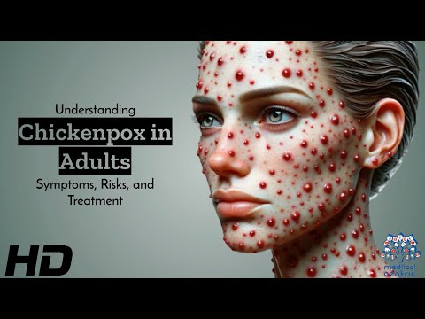 Facing Chickenpox as an Adult: Risks, Symptoms, and Healing