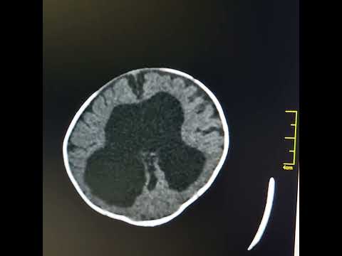 Moderate hydrocephalus, mild cerebral atrophy and Dandy - Walkar variant.