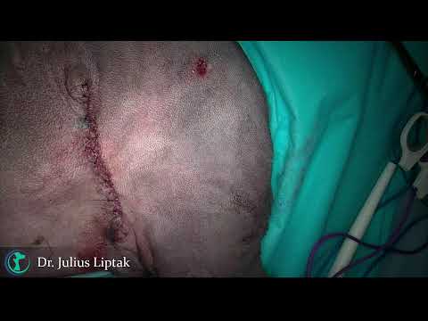 Wide MCT Resection and Sentinel (Axillary) Lymph Node Excision, 2025/04/17