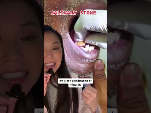 Biggest salivary stone I’ve ever seen! #salivarystone #tonsilstone #mouthstone #mouthsore #dentist