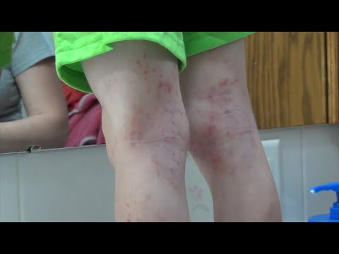 Mayo Clinic Minute - Atopic dermatitis triggers