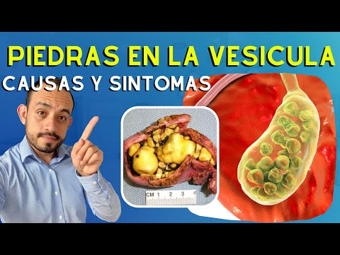¿Qué es la 𝗩𝗲𝘀𝗶𝗰𝘂𝗹𝗮 𝗕𝗶𝗹𝗶𝗮𝗿, la Colecistitis o Colelitiasis? ✅ 𝗚𝗨𝗜́𝗔 𝗗𝗘𝗙𝗜𝗡𝗜𝗧𝗜𝗩𝗔