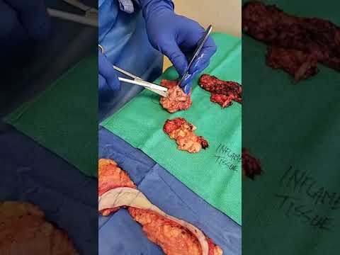 Dr. Khan Shows Worst-Case Explant Scenario - Necrotic Fat, Silicone Granulomas & More