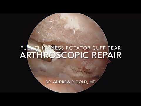 Arthroscopic rotator cuff repair of a full-thickness tear of the shoulder
