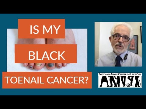 Could My Black Toenail Be Cancer? Don't Ignore These Signs? | Foot and ...