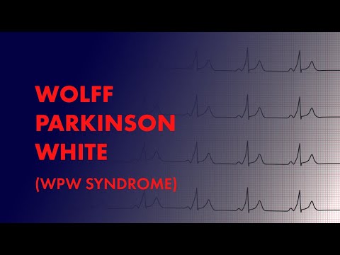 Wolff Parkinson White (WPW Syndrome) - EKG (ECG) Interpretation