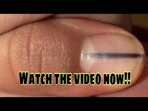 A black line on your nails could be a sign of cancer!! Did you know?