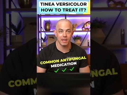Treat Tinea Versicolor