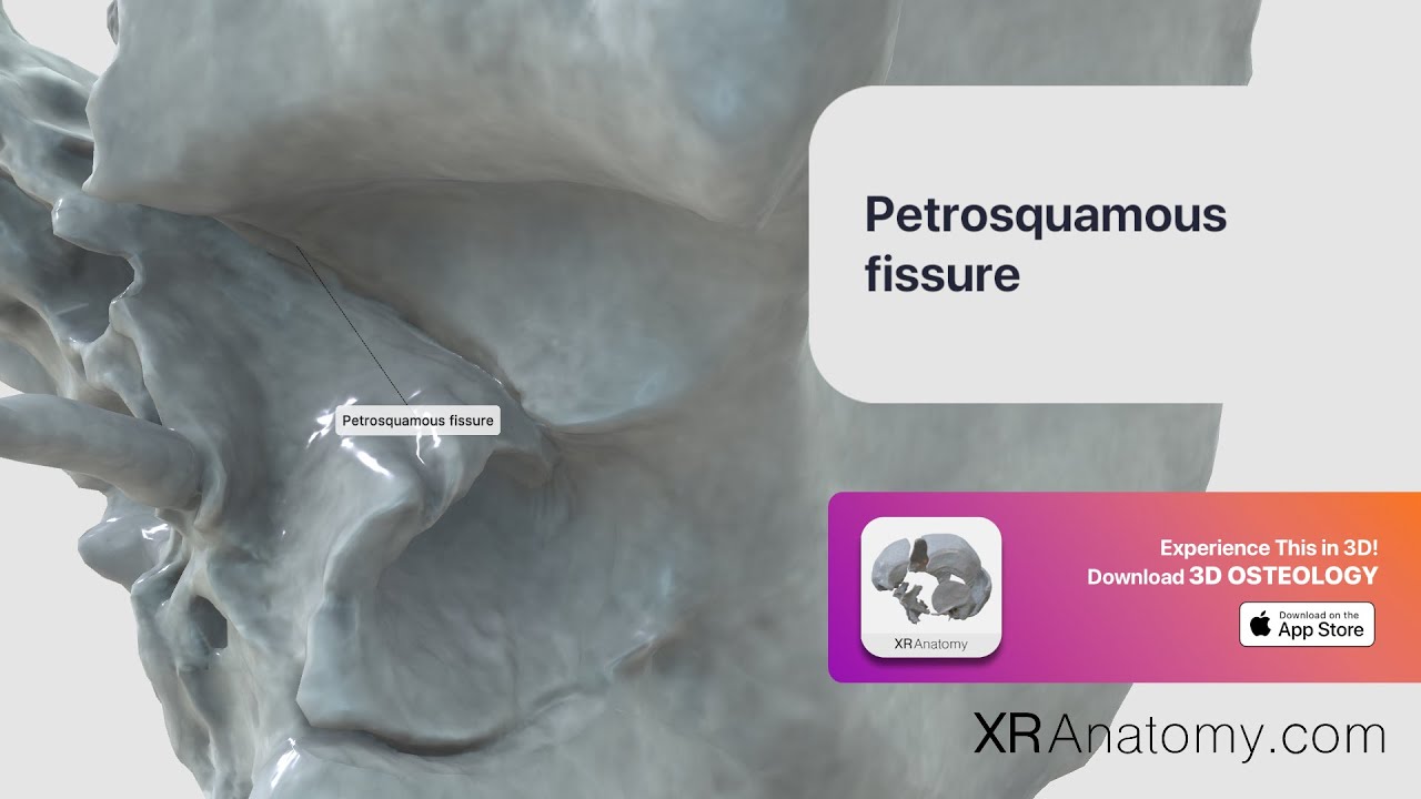 Temporal Bone - Petrosquamous fissure