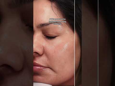 My Patient Results From MELASMA *ERASING* Treatments
