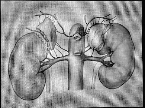 CKD Staging & Complications