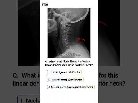 ☢️X-ray Quiz: Cervical Spine Finding!🤔 #radiologybuzz #anatomy