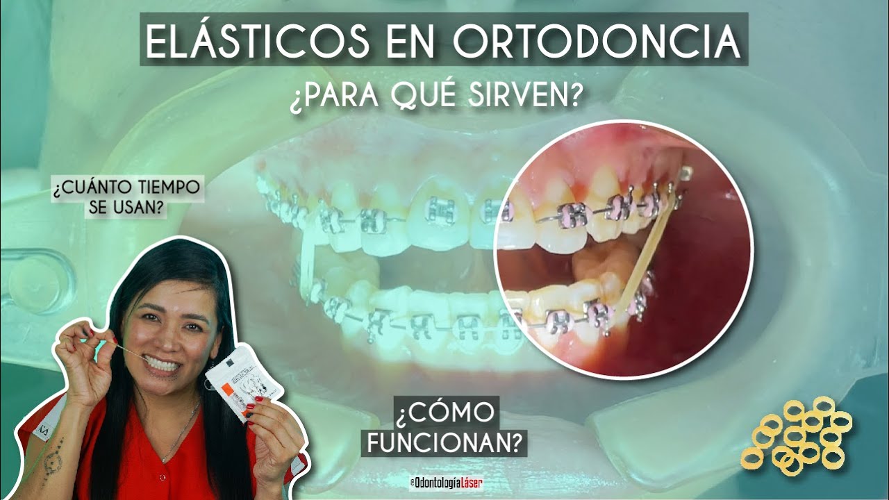 Elastics in Orthodontics 😬 What are they for? How do they work? - Laser Dentistry 🦷