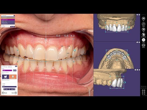 EXOCAD EXPLAINED – Exocad Elite