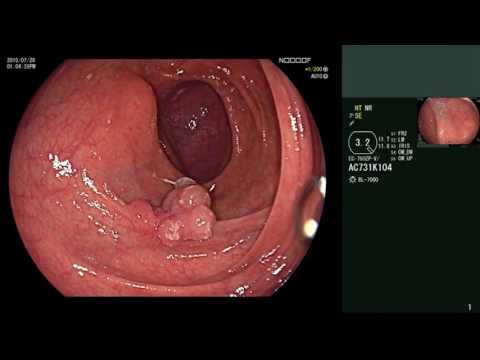 Endoscopic diagnosis of colon polyps using the NICE classification
