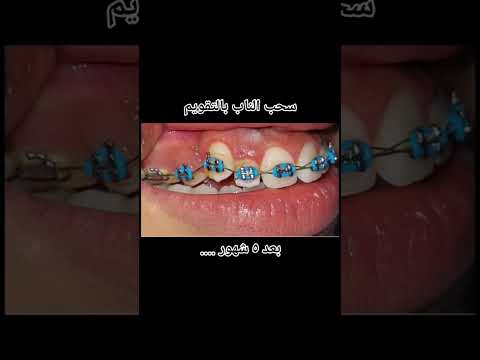 سحب الناب بتقويم الاسنان|| حل مشكلة رفع الناب العلوي||تقويم الاسنان قبل وبعد||دكتور عبدالله سلطان