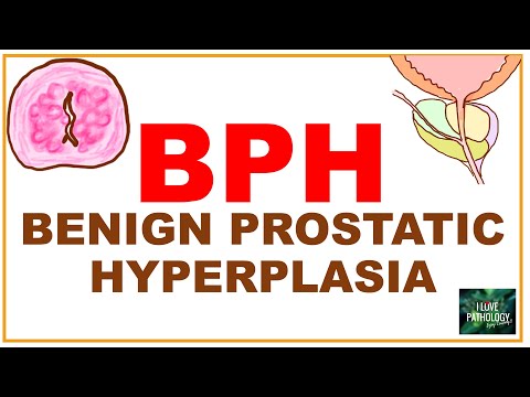 Benign Prostatic Hyperplasia ( BPH) etiopathogenssis, Pathology & clinical features