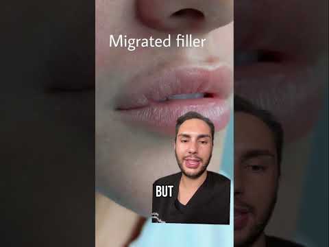Cold Sores From Lip Filler & Migration